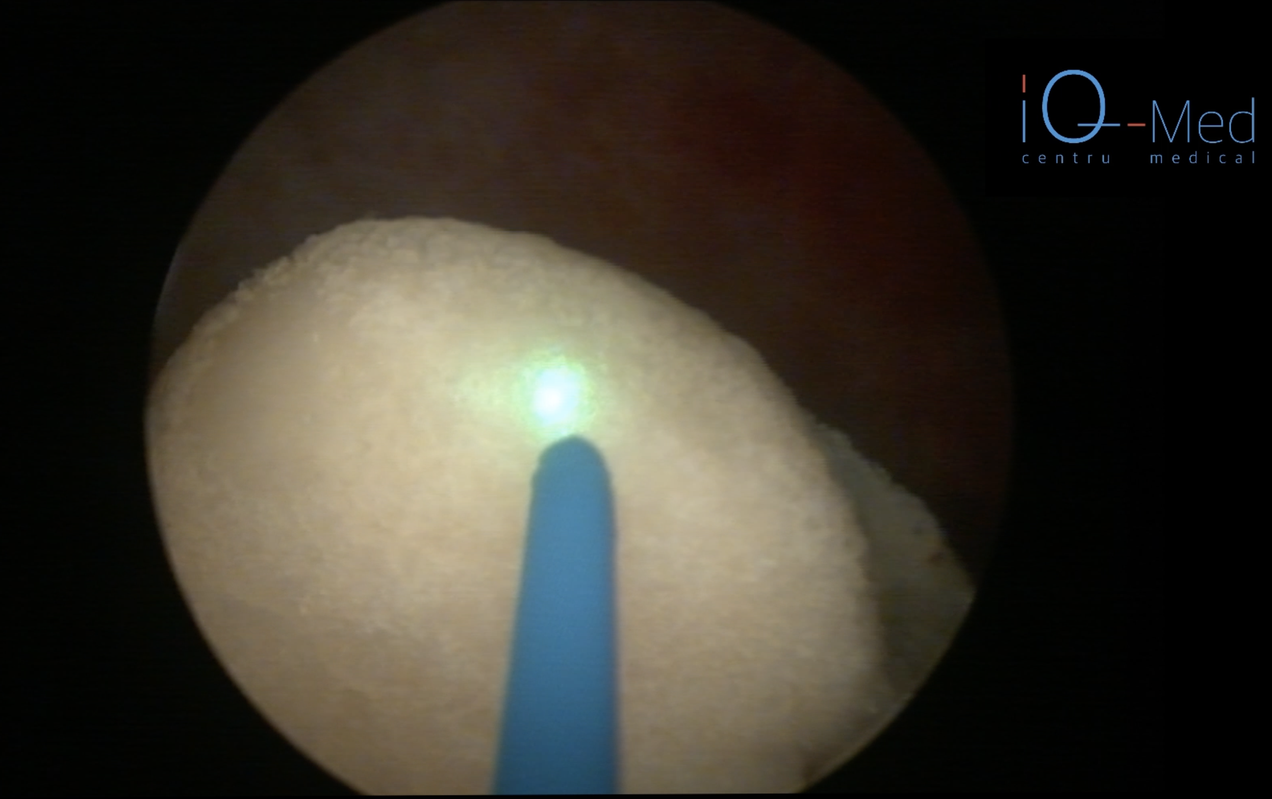 Cistoscopie cu litotritie endoscopica | Dr. Marcel Rad